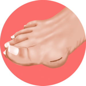 Minimally Invasive Bunion Foot Surgery: Ankle & Foot Centers of Georgia ...