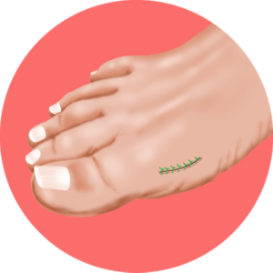 Minimally Invasive Bunion Surgery | miniBunion 3D Surgery