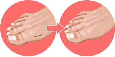 Minimally Invasive Bunion Foot Surgery: Ankle & Foot Centers of Georgia ...