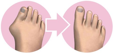 Minimally Invasive Bunion Surgery | miniBunion 3D Surgery