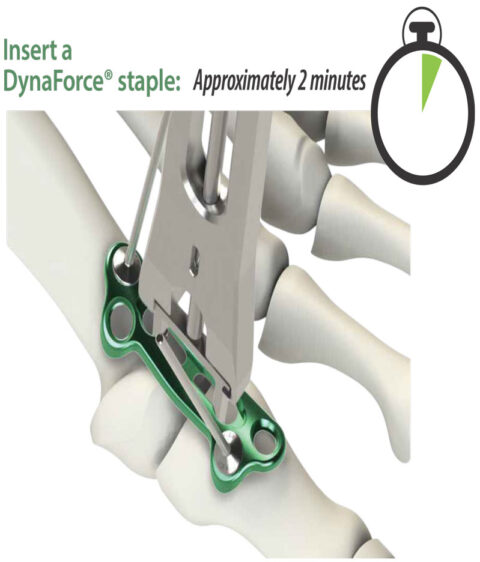 DynaForce Staple Compression Plates - MINIBunion™